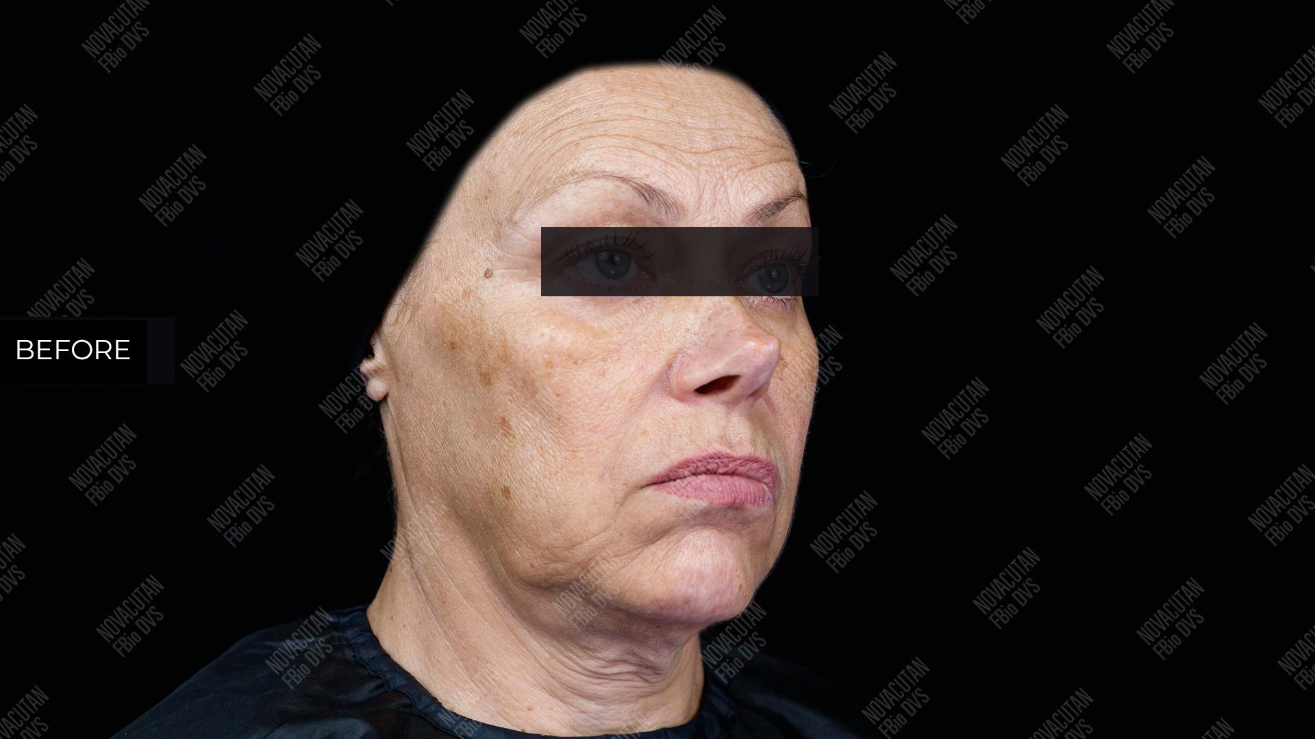 FBio DVS | Novacutan